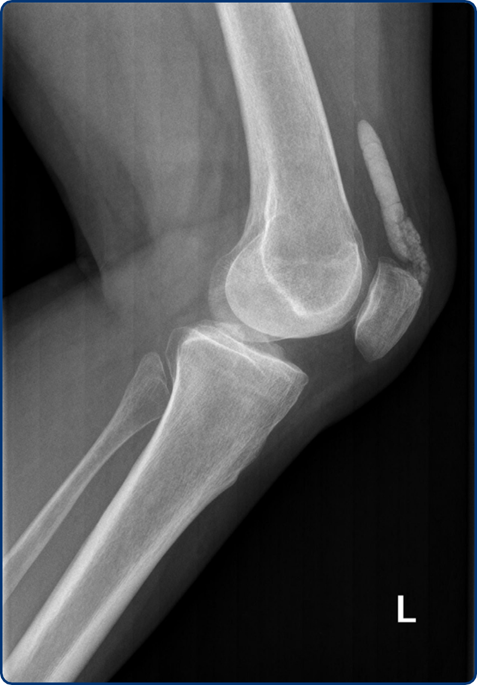 TenJet Patient Story: "I’m so grateful for TenJet" | HydroCision